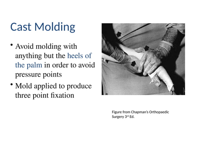 techniques of cast application and cast complications.pptx