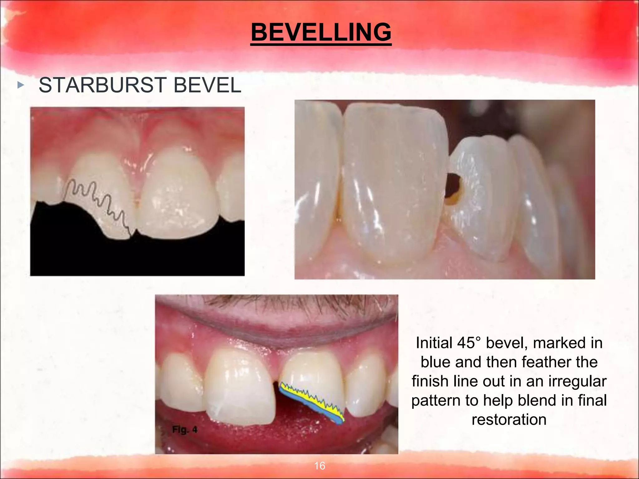 Techniques of direct composite restoration | PPT