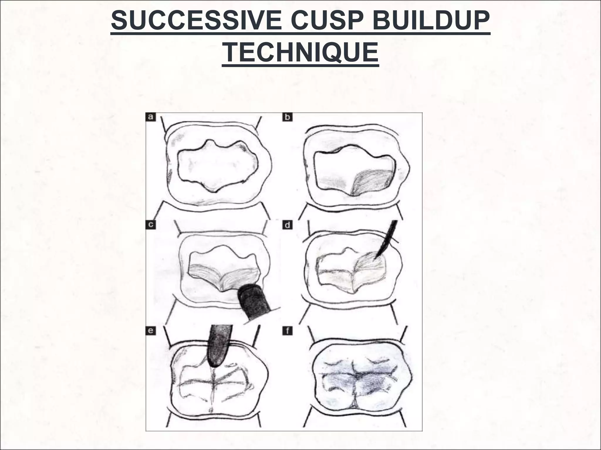 Techniques of direct composite restoration | PPT