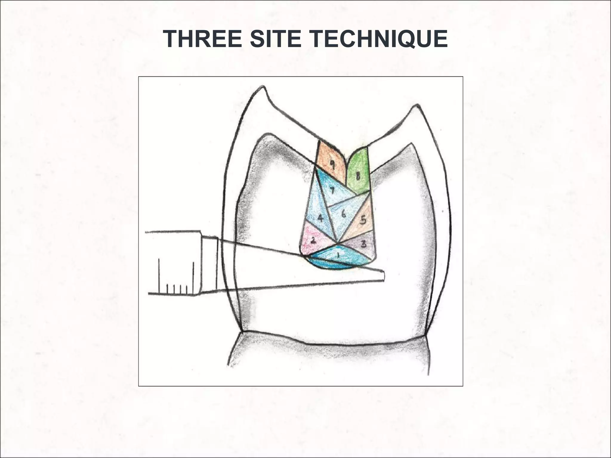 Techniques of direct composite restoration | PPT
