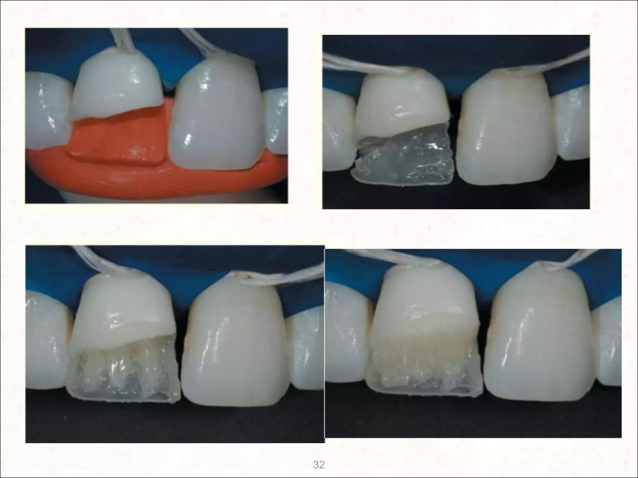 Techniques of direct composite restoration | PPT