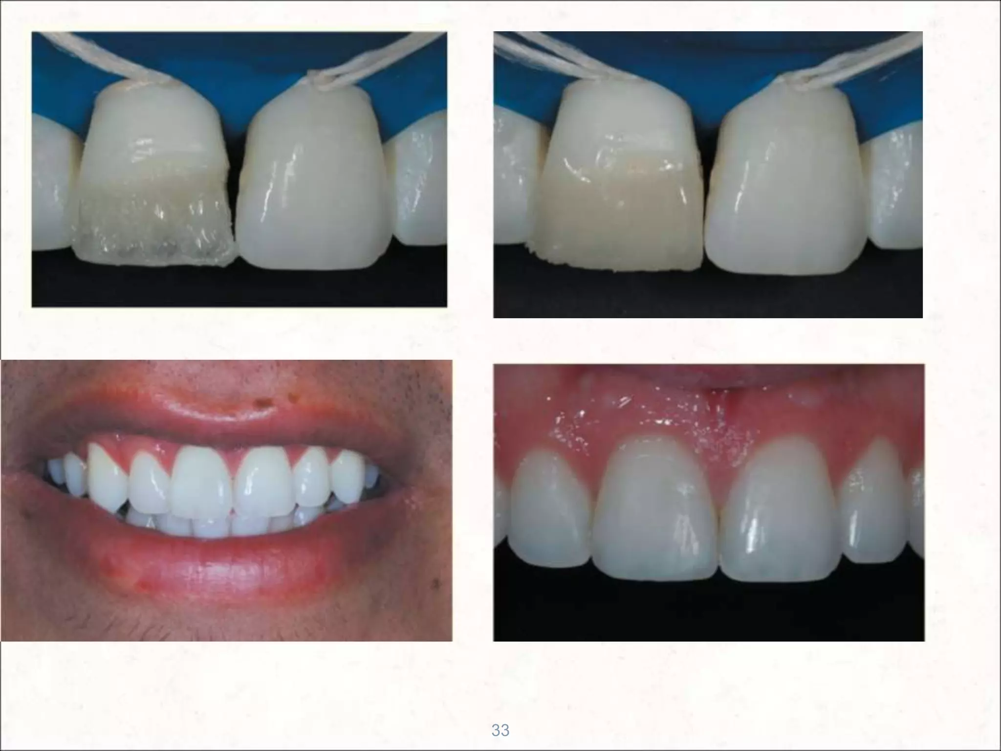 Techniques of direct composite restoration | PPT