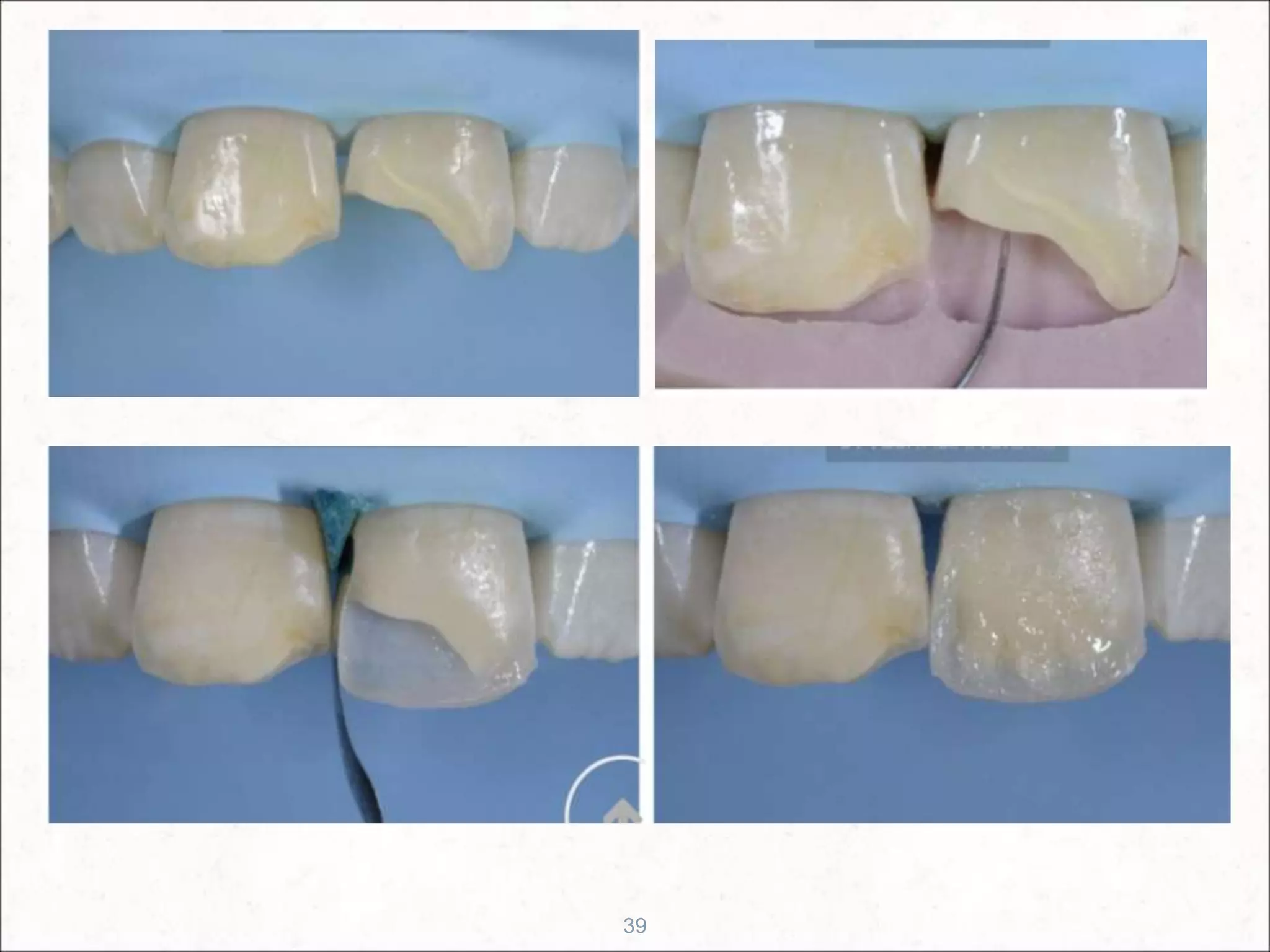 Techniques of direct composite restoration | PPT