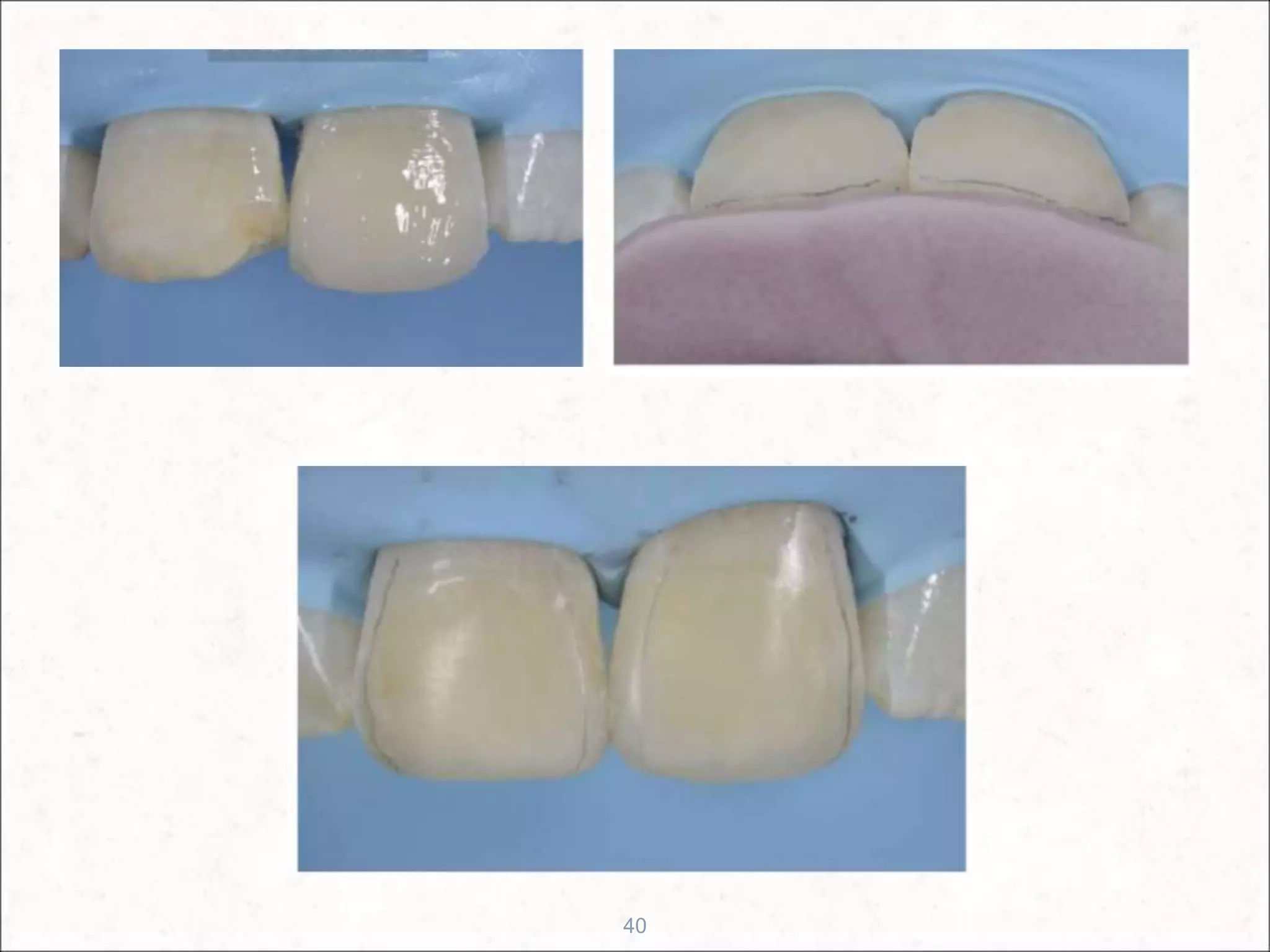 Techniques of direct composite restoration | PPT