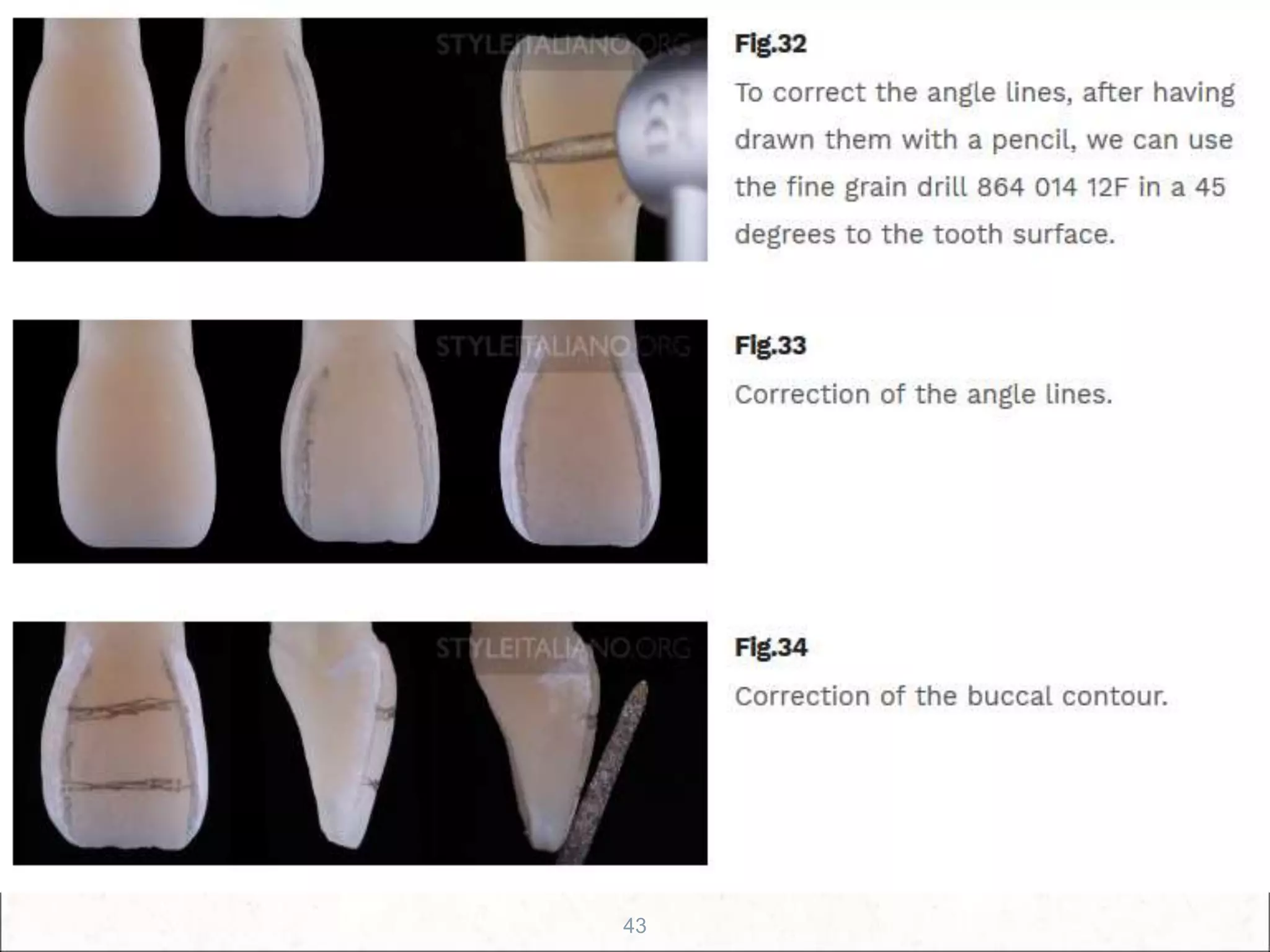 Techniques of direct composite restoration | PPT