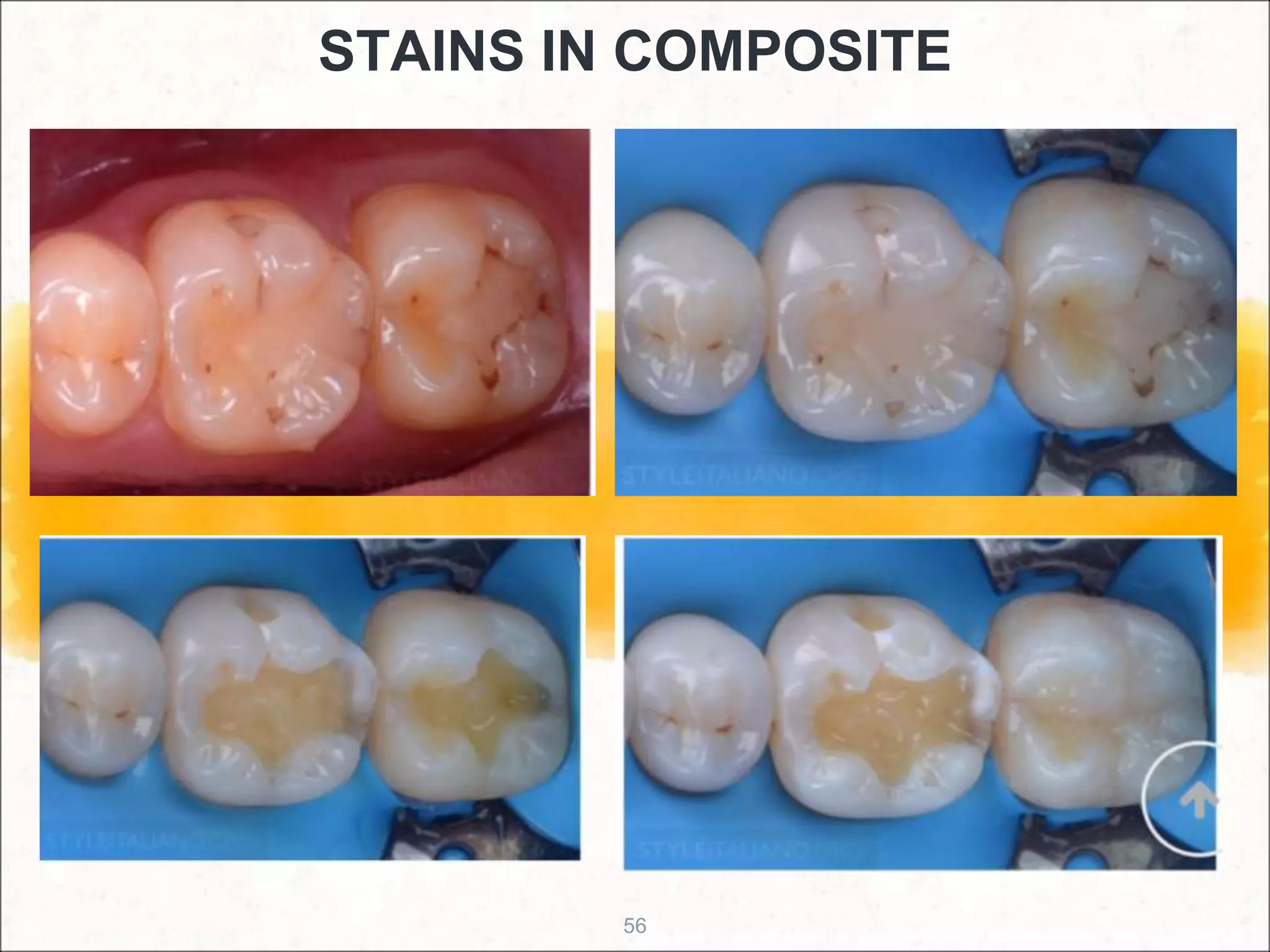 Techniques of direct composite restoration | PPT