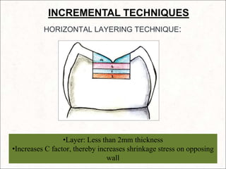 Techniques of direct composite restoration | PPT