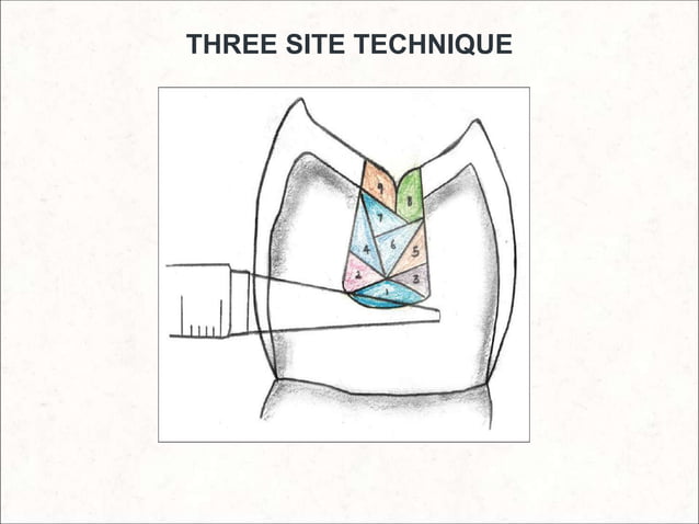 Techniques of direct composite restoration | PPT