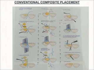Techniques of direct composite restoration | PPT