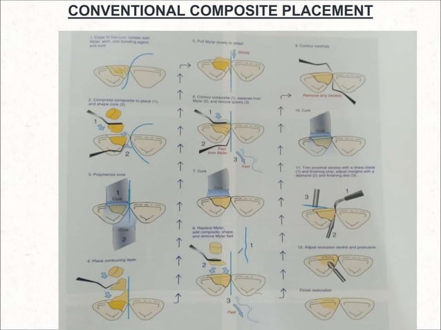 Techniques of direct composite restoration | PPT
