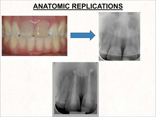 Techniques of direct composite restoration | PPT