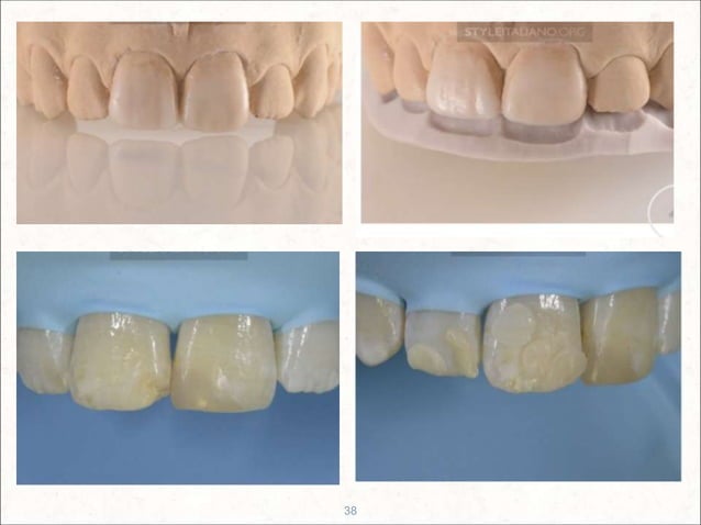 Techniques of direct composite restoration | PPT