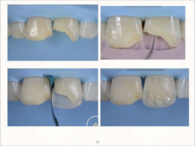 Techniques of direct composite restoration | PPT