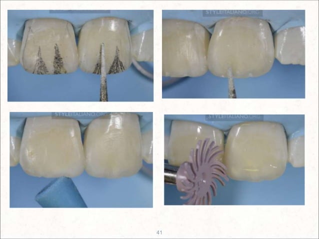 Techniques of direct composite restoration | PPT