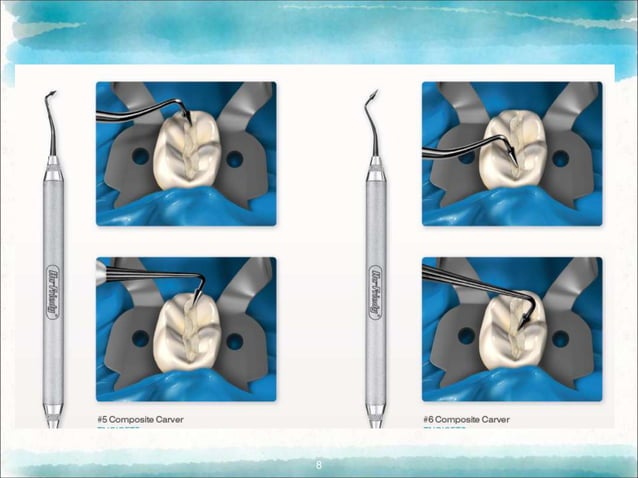 Techniques of direct composite restoration | PPT