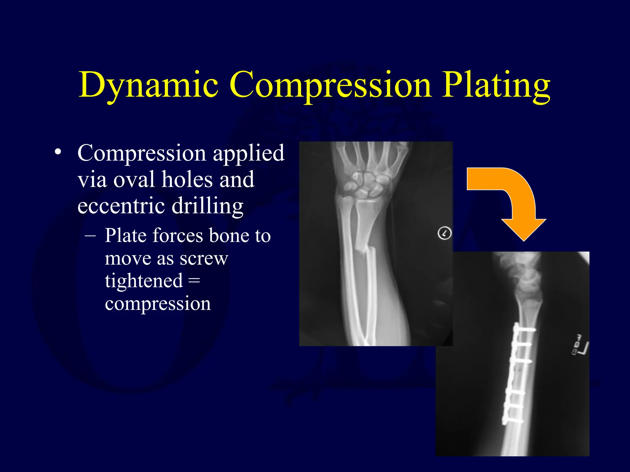 basic methods of fracture fixation and stepwise approach | PPT