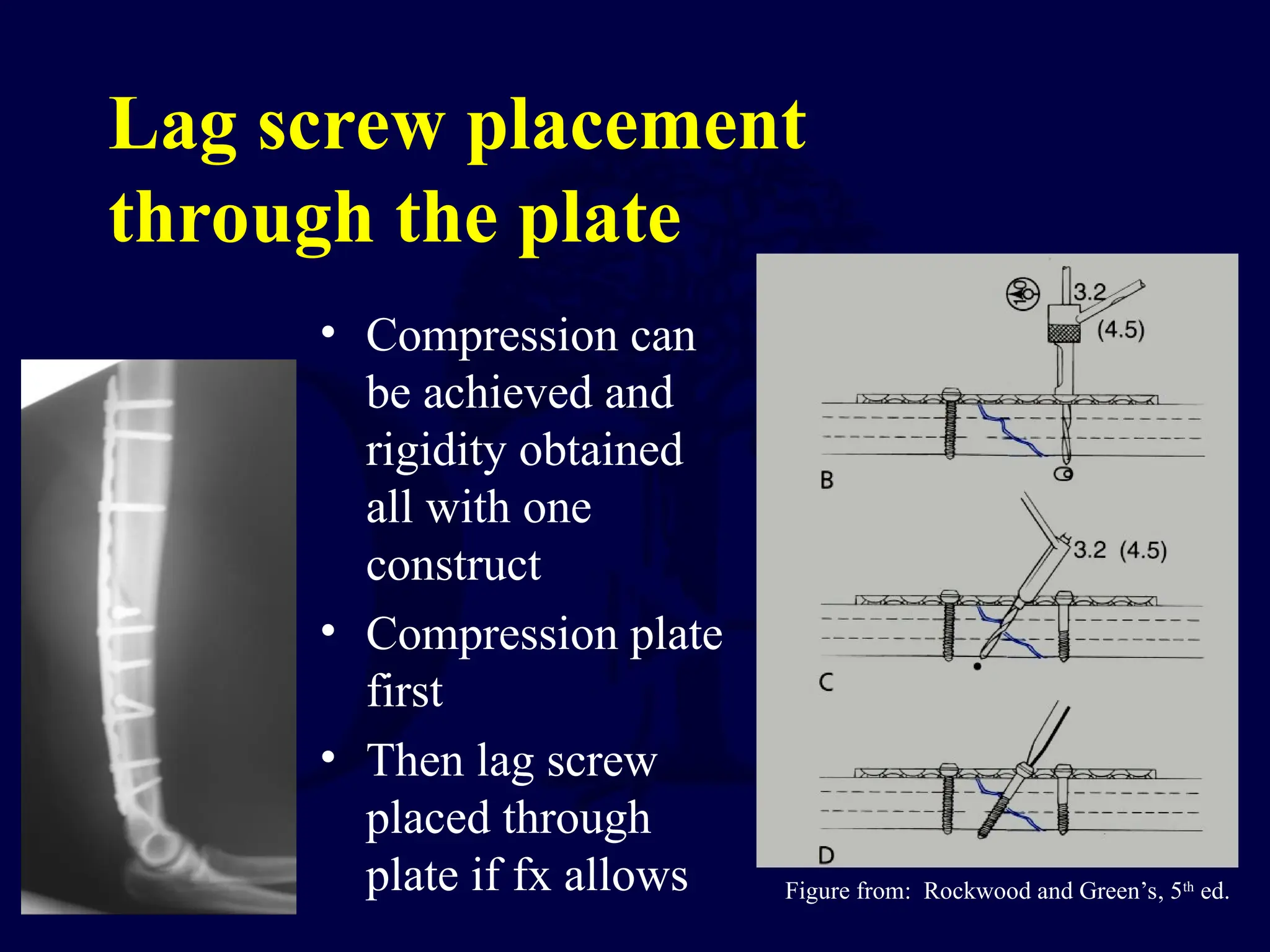basic methods of fracture fixation and stepwise approach | PPT