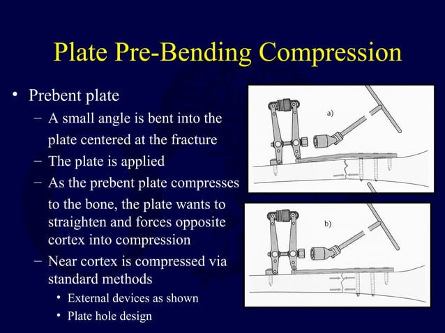 basic methods of fracture fixation and stepwise approach | PPT