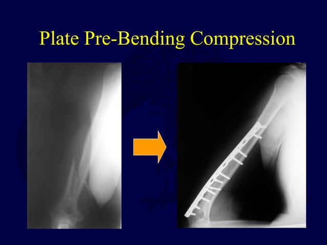 basic methods of fracture fixation and stepwise approach | PPT