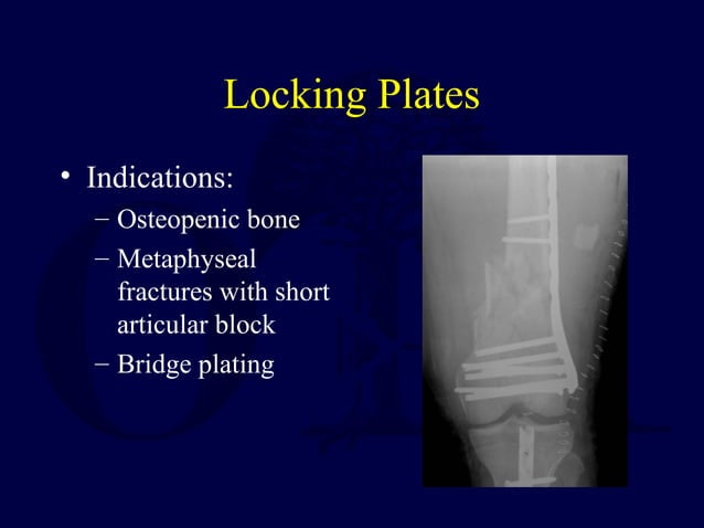 basic methods of fracture fixation and stepwise approach | PPT