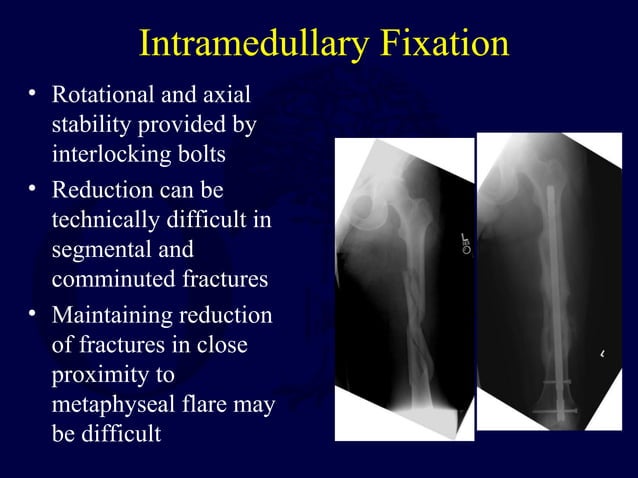 basic methods of fracture fixation and stepwise approach | PPT