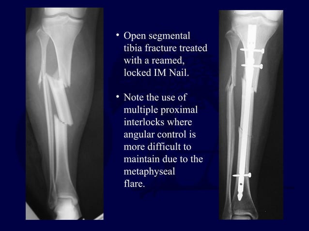 basic methods of fracture fixation and stepwise approach | PPT