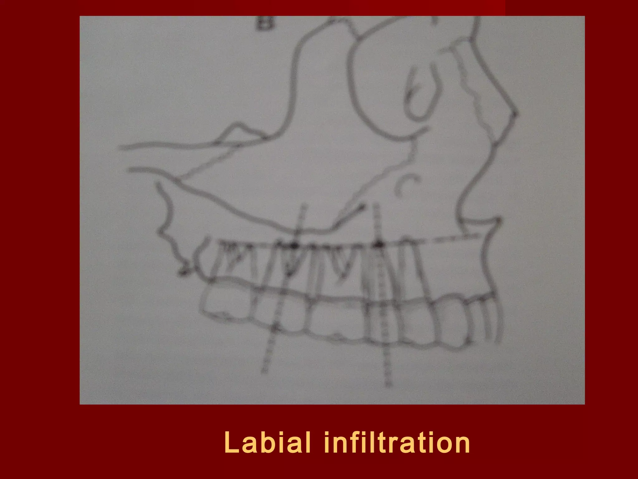 Techniques of Local Anesthesia | PPT