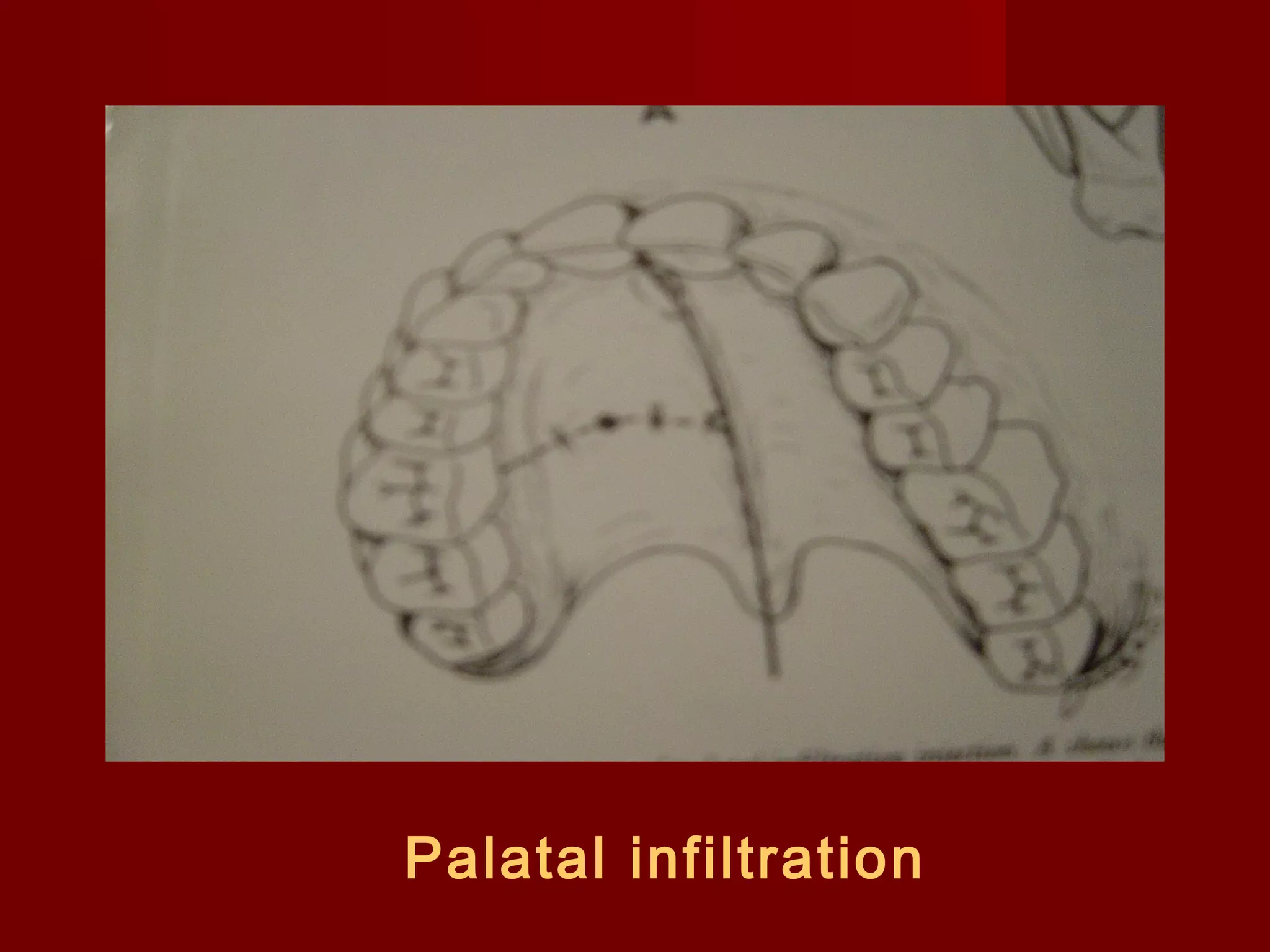 Techniques of Local Anesthesia | PPT