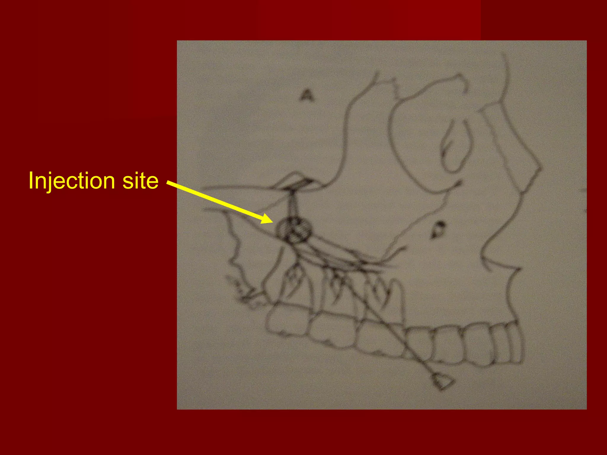 Techniques of Local Anesthesia | PPT