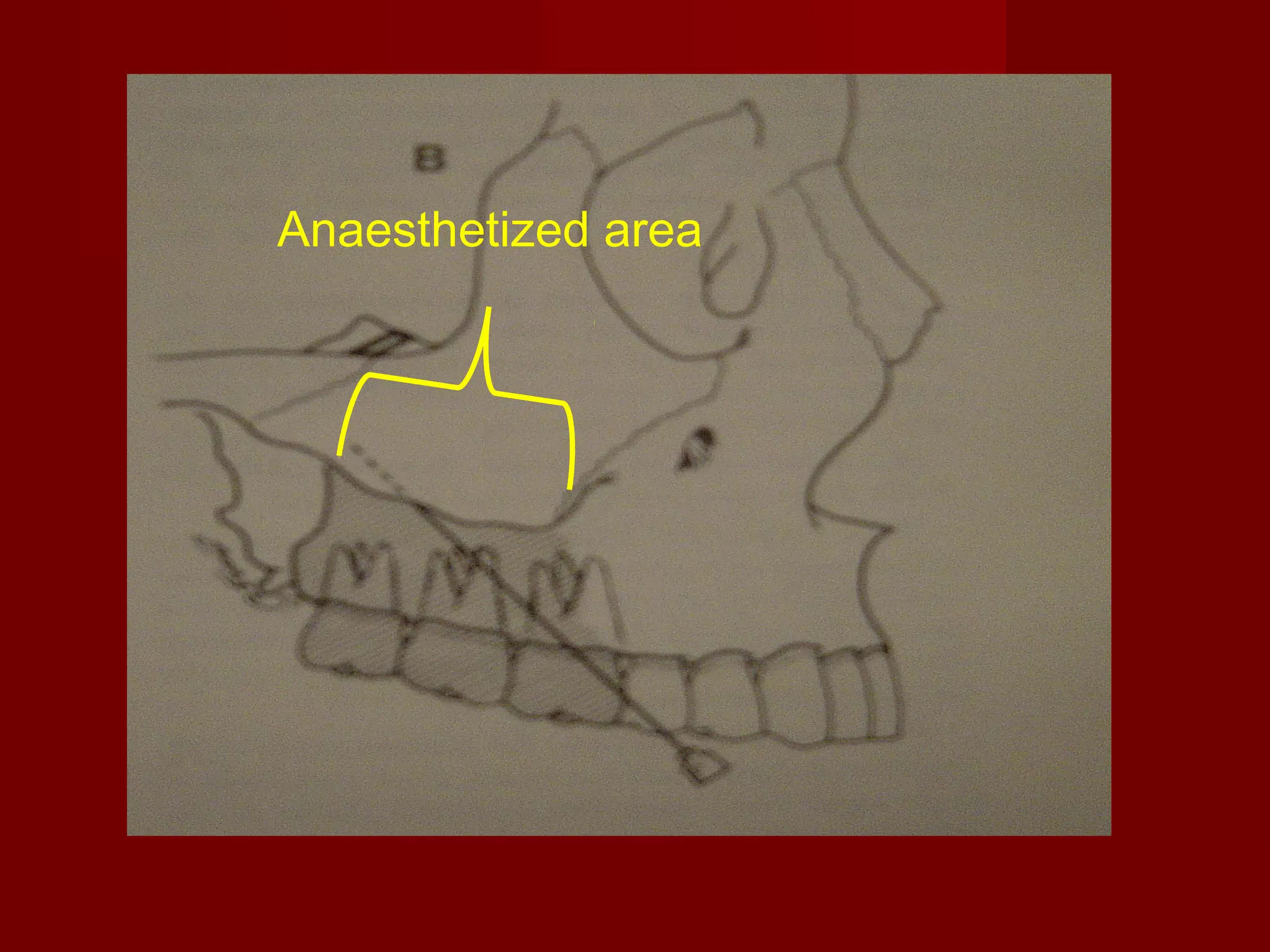 Techniques of Local Anesthesia | PPT