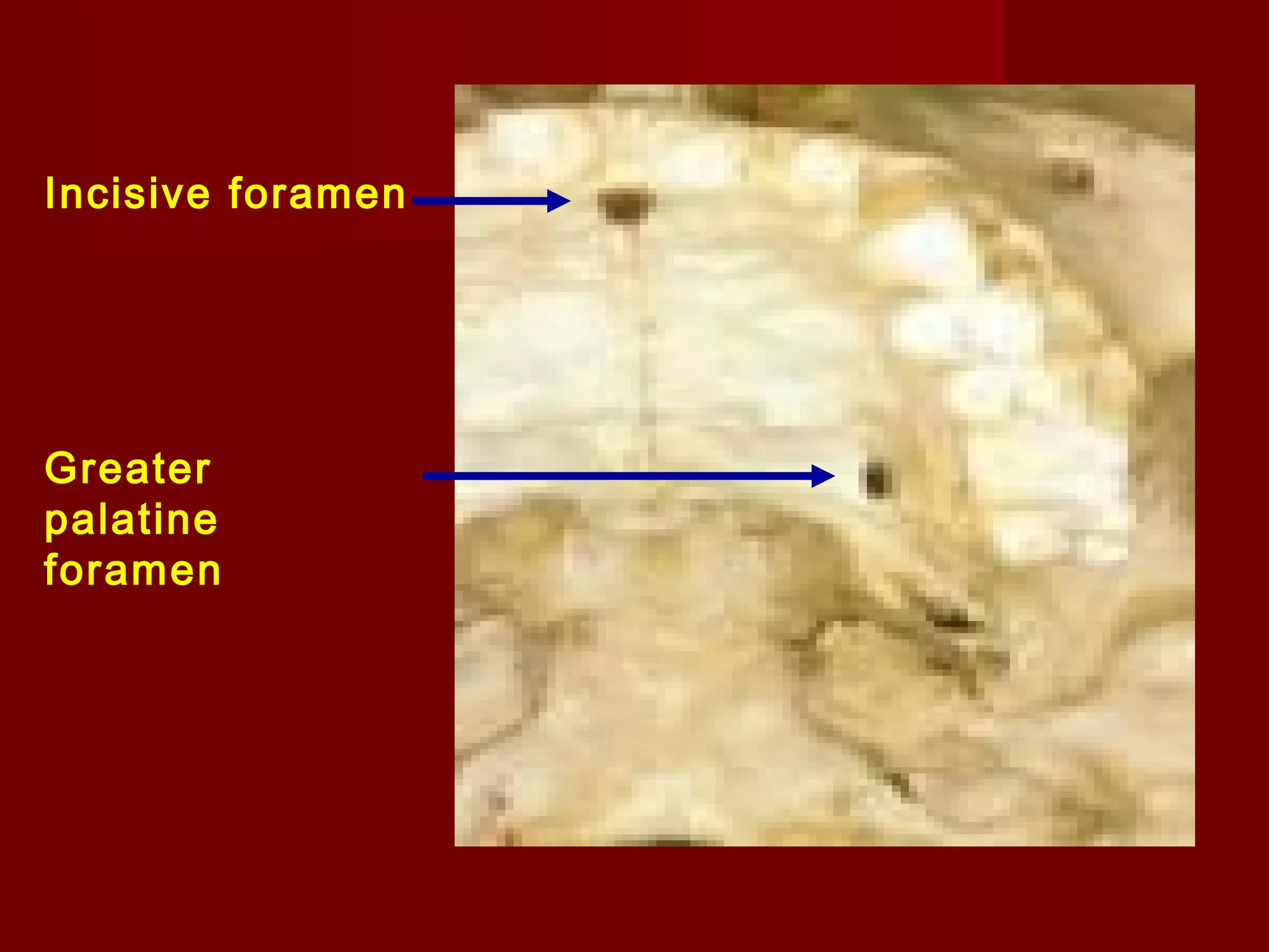 Techniques of Local Anesthesia | PPT