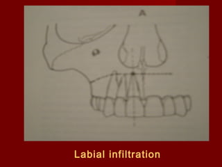 Techniques of Local Anesthesia | PPT