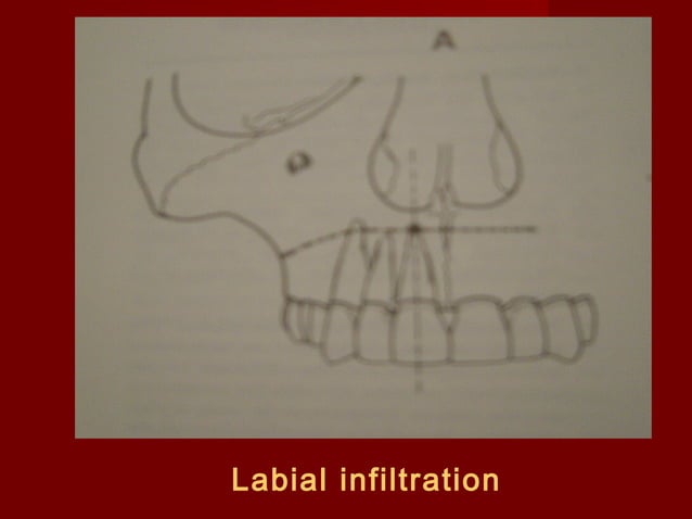 Techniques of Local Anesthesia | PPT
