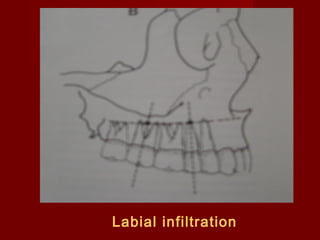 Techniques of Local Anesthesia | PPT