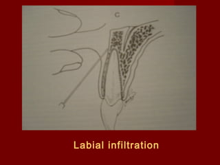 Techniques of Local Anesthesia | PPT