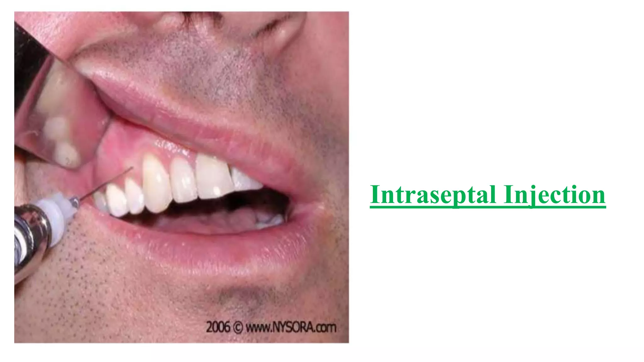 Techniques of local anaesthesia | PPTX
