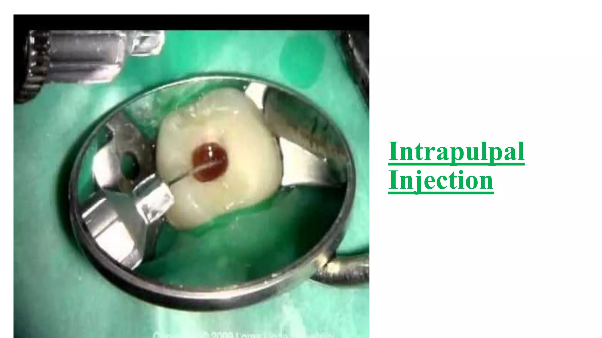 Techniques of local anaesthesia | PPTX