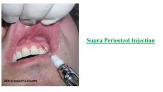 Techniques of local anaesthesia | PPTX