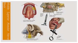 Techniques of local anaesthesia | PPTX