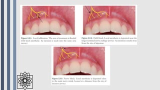 Techniques of local anesthesia in dentistry IN A NUTSHELL | PPTX