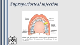 Techniques of local anesthesia in dentistry IN A NUTSHELL | PPTX