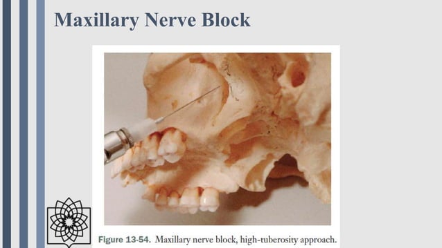 Techniques of local anesthesia in dentistry IN A NUTSHELL