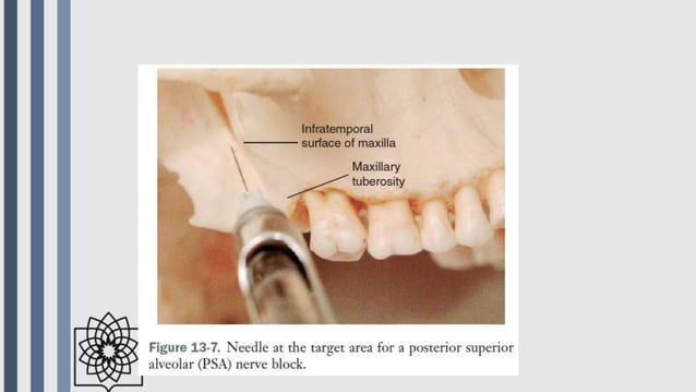Techniques of local anesthesia in dentistry IN A NUTSHELL