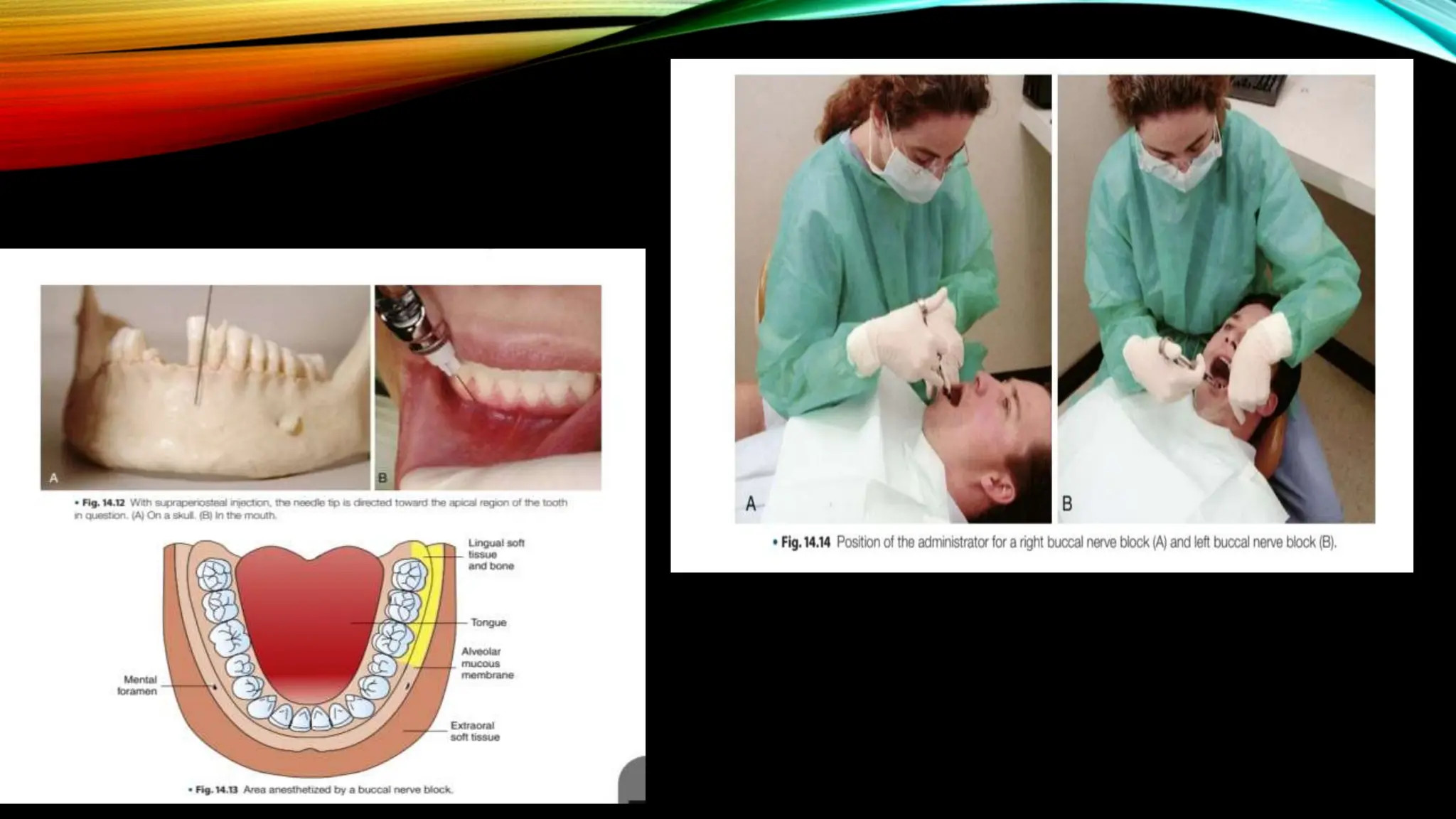 Techniques of mandibular anesthesia.pptx