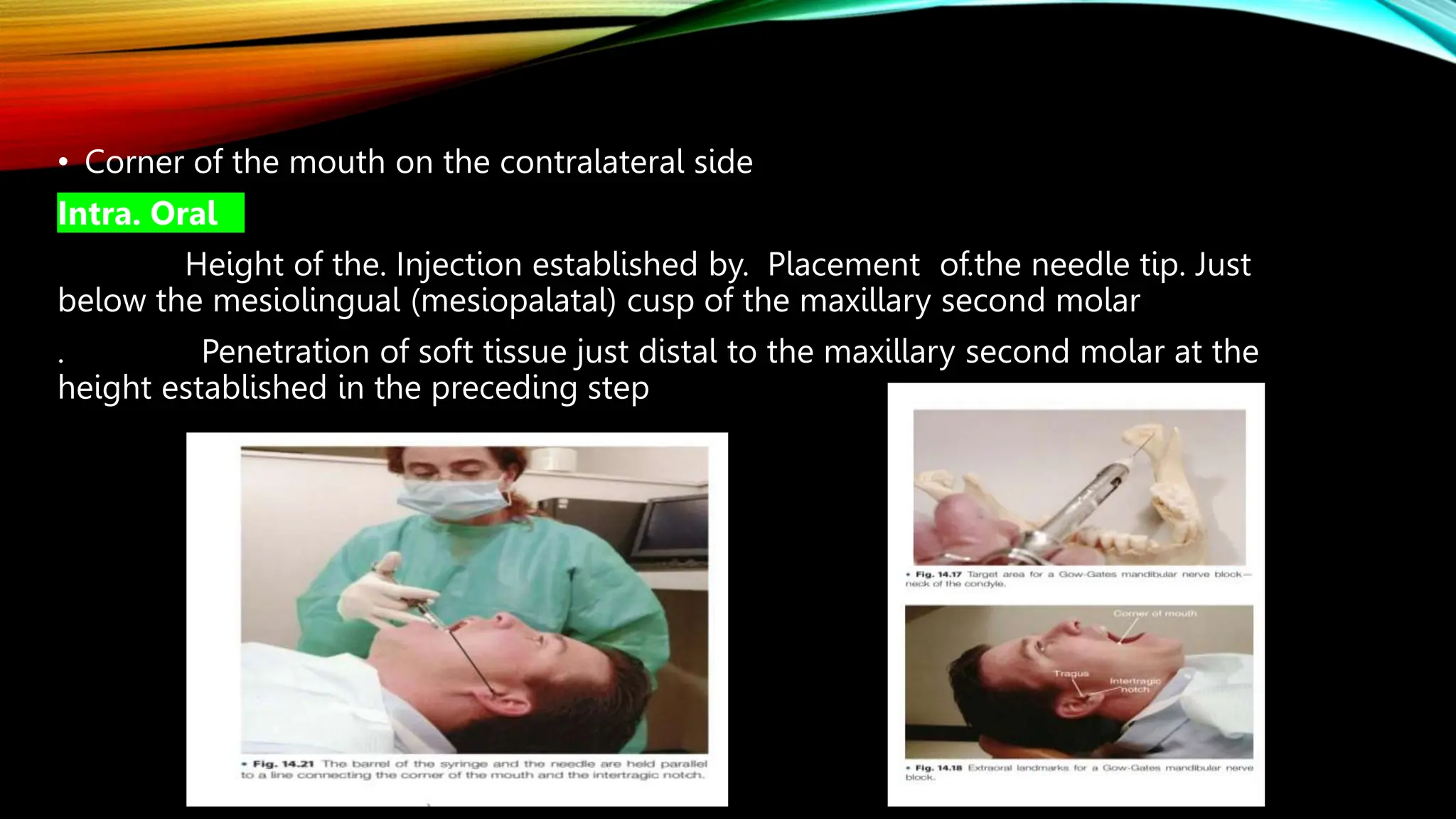 Techniques of mandibular anesthesia.pptx