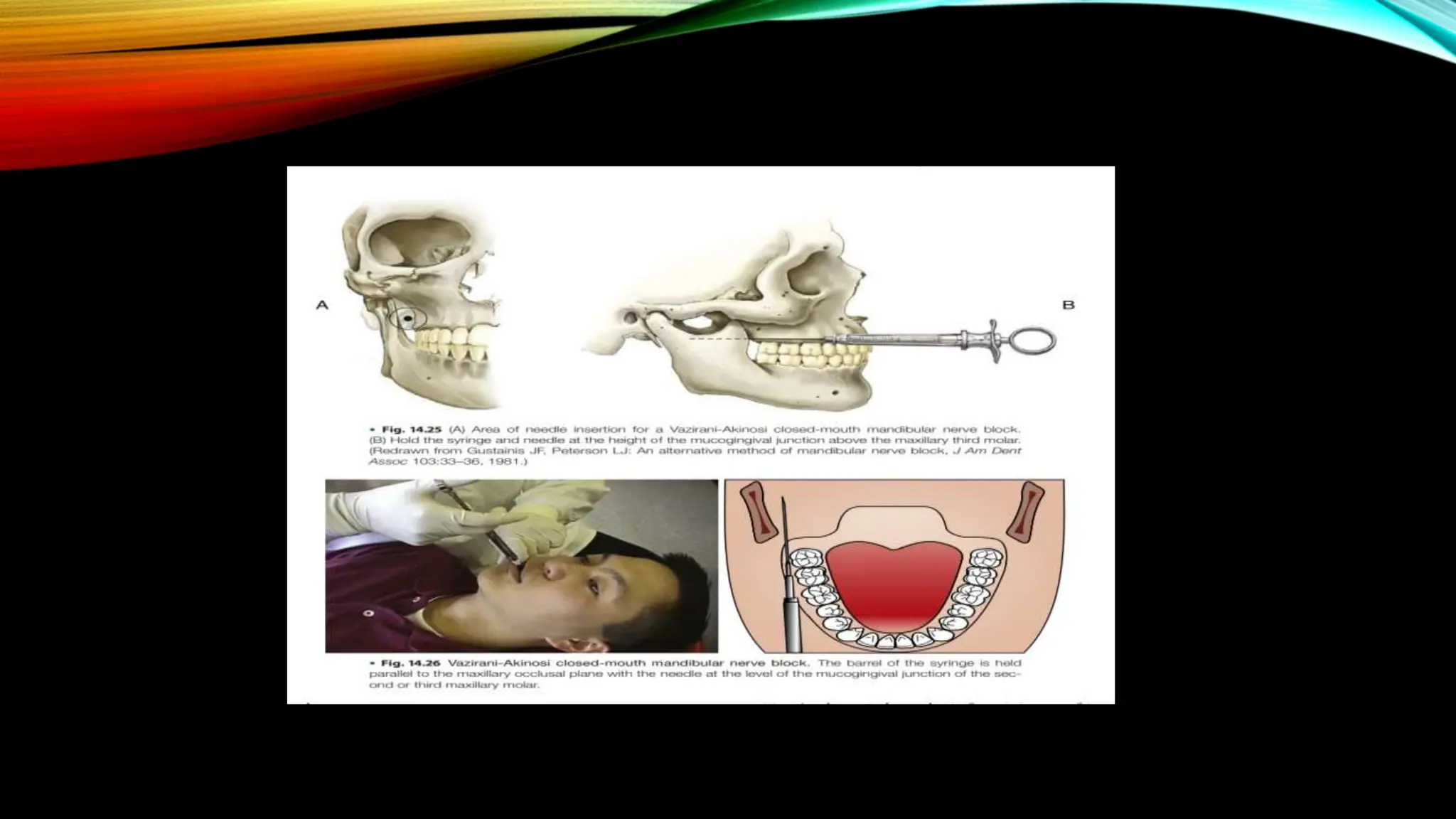 Techniques of mandibular anesthesia.pptx