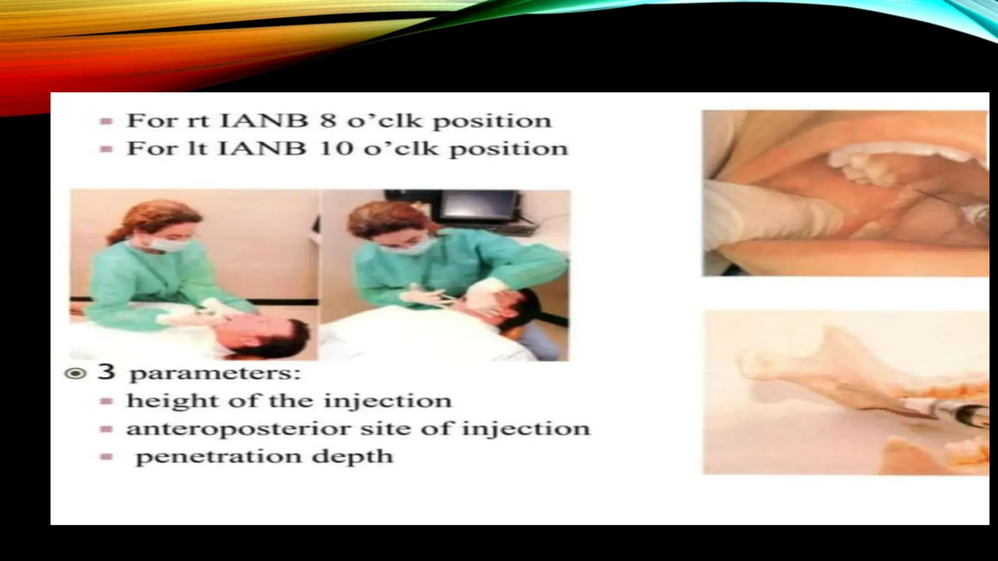 Techniques of mandibular anesthesia.pptx