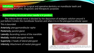 Techniques of mandibular anesthesia.pptx