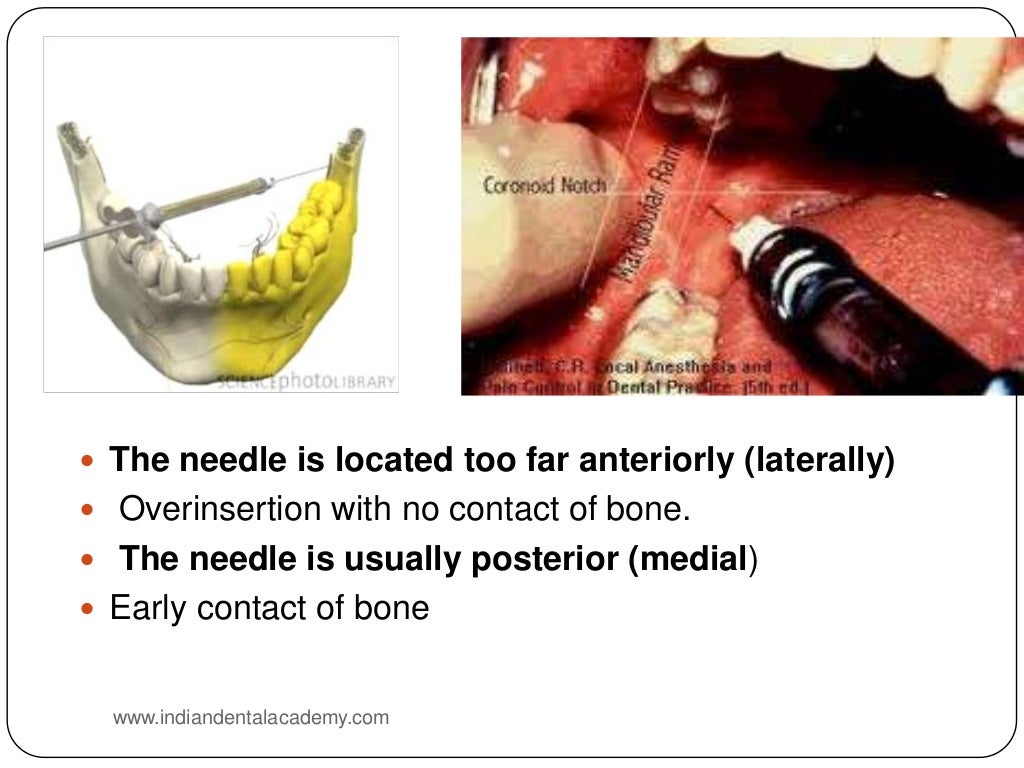 Techniques of mandibular anesthesia new /certified fixed orthodont…