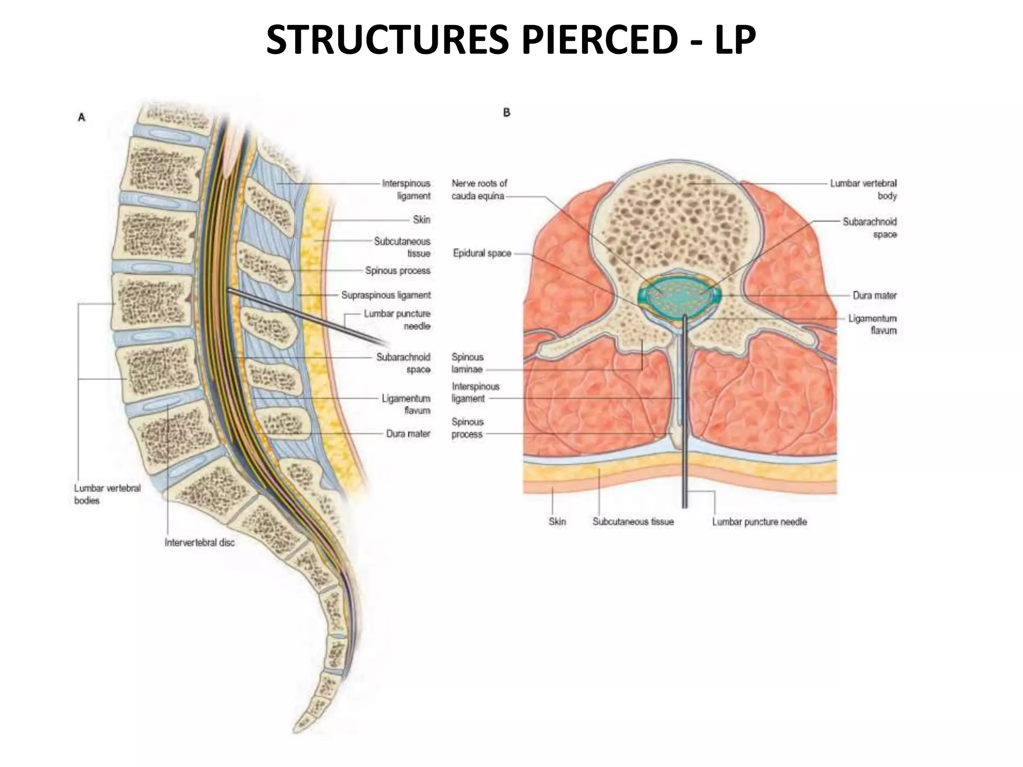 Techniques of spinal anaesthesia | PPTX
